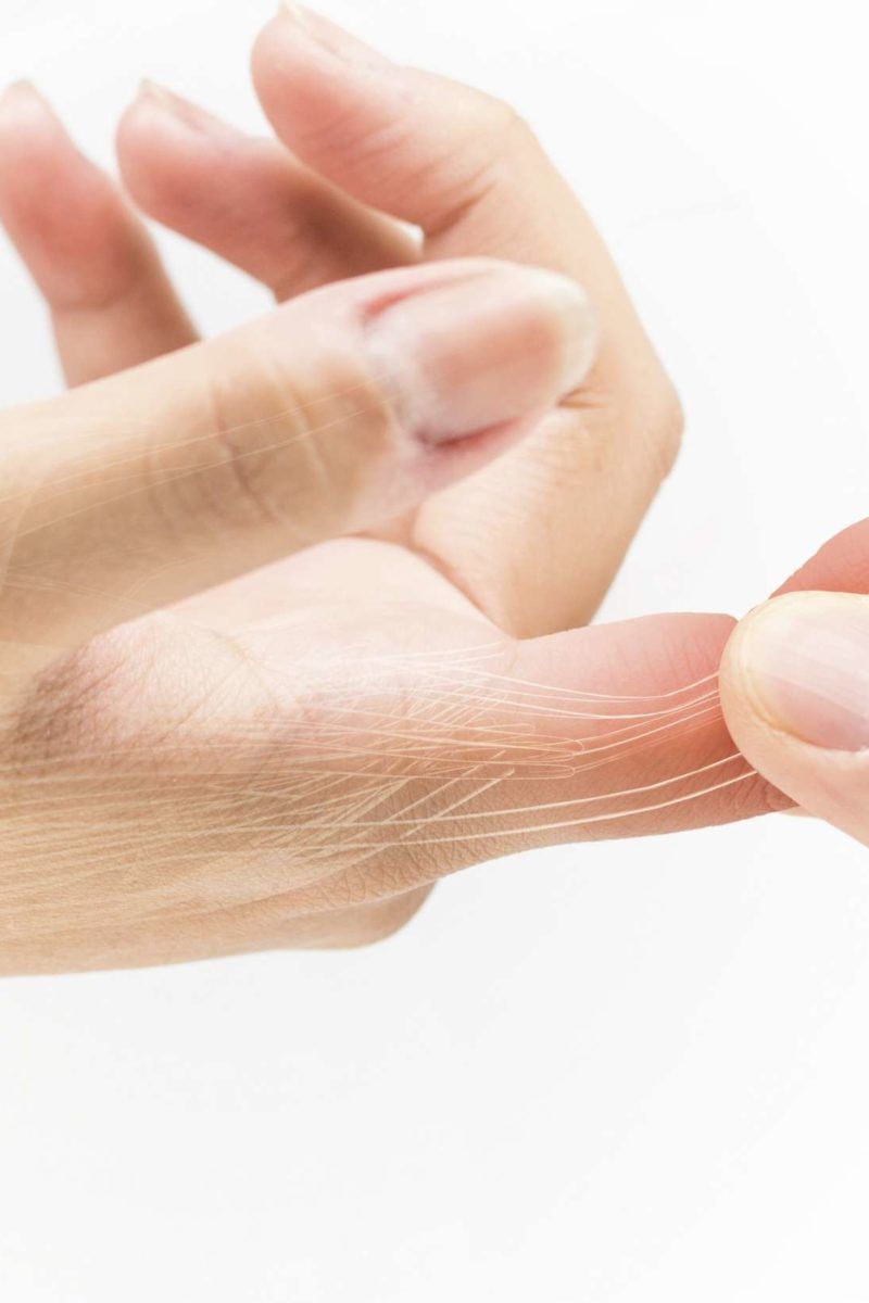 Sprained finger: Symptoms, treatment, and recovery