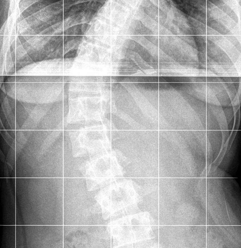 Dextroscoliosis: Types, exercises, and treatment