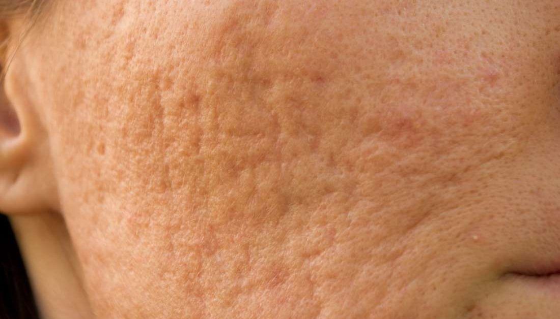 Facials for acne scars store