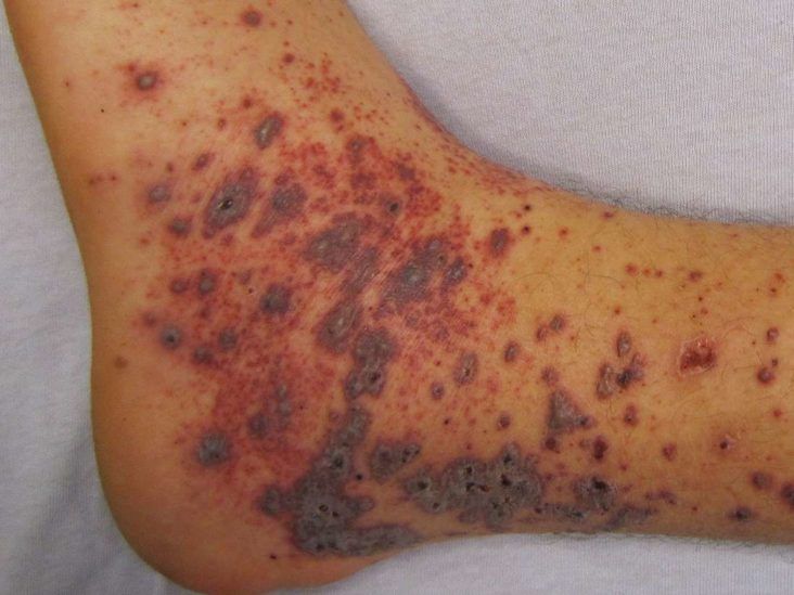 Calling All Google Doctors Help With Petechiae Rash Reply To