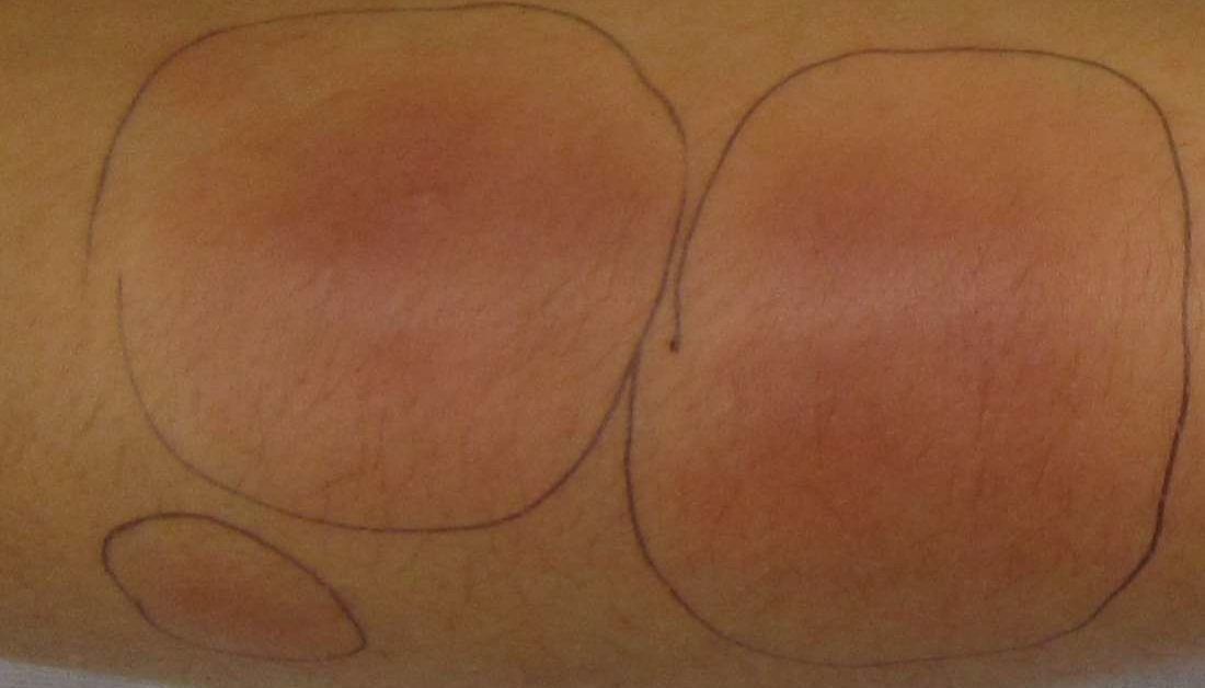 Panniculitis: Symptoms, types, and treatment