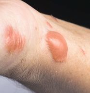 Burn Scars Treatment Removal And Prevention Burn Scars Treatment Removal And Prevention