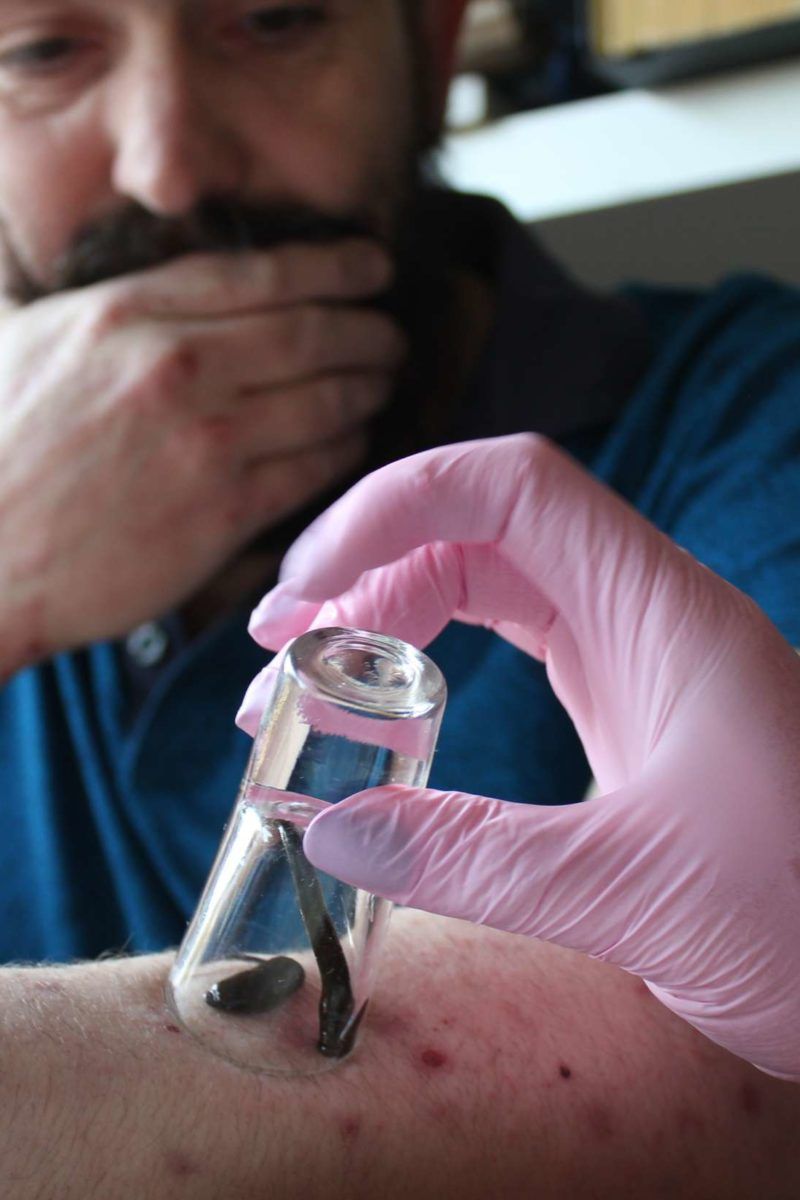 Leech therapy: What does it feel like and does it work?