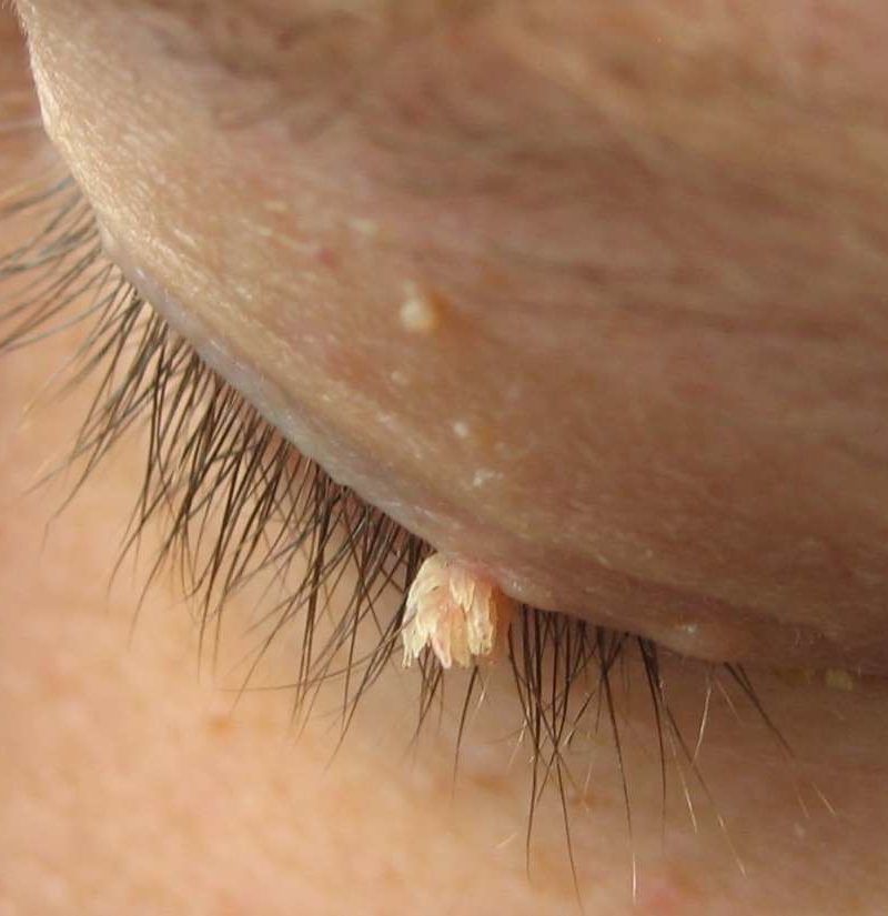 Filiform warts: What they look like, treatment, and causes