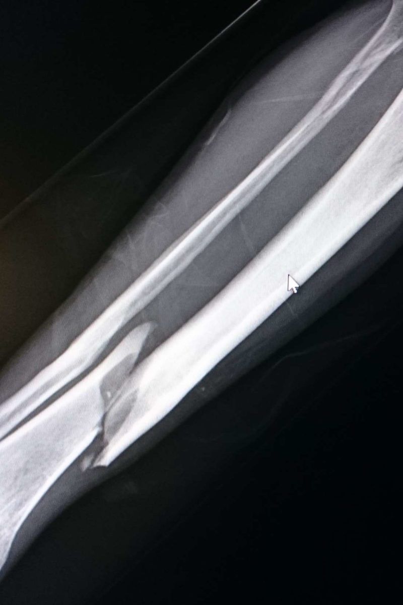 Tibia fracture: Types, symptoms, and treatment