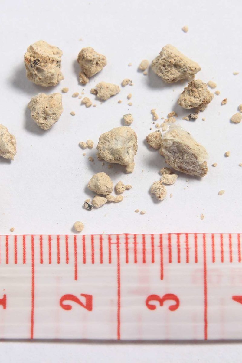 Certain antibiotics increase kidney stone risk