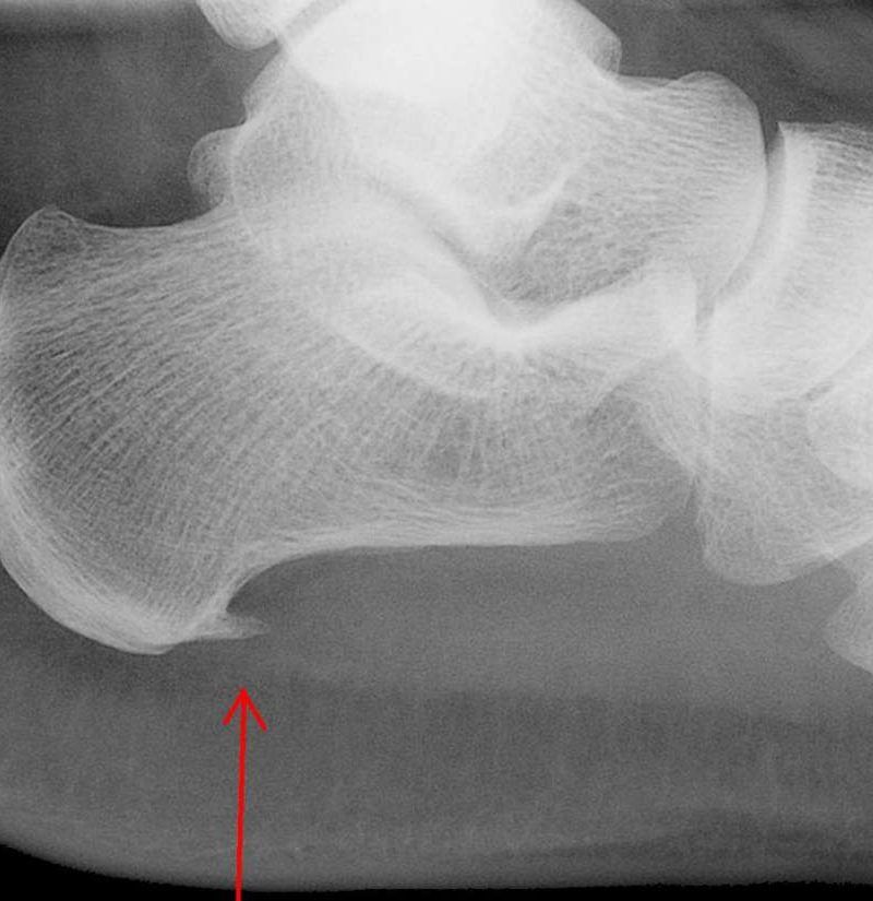 Exostosis: Causes, types, and treatment