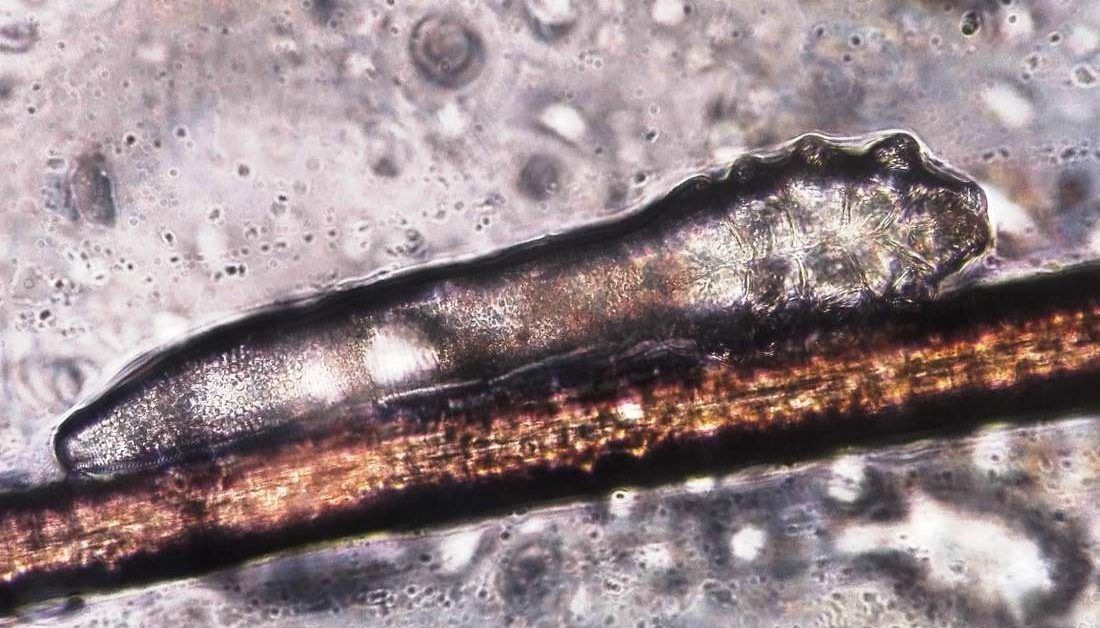 Demodex folliculorum: Causes, symptoms, and treatment
