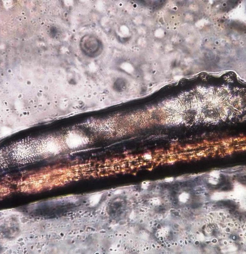 Demodex folliculorum: Causes, symptoms, and treatment