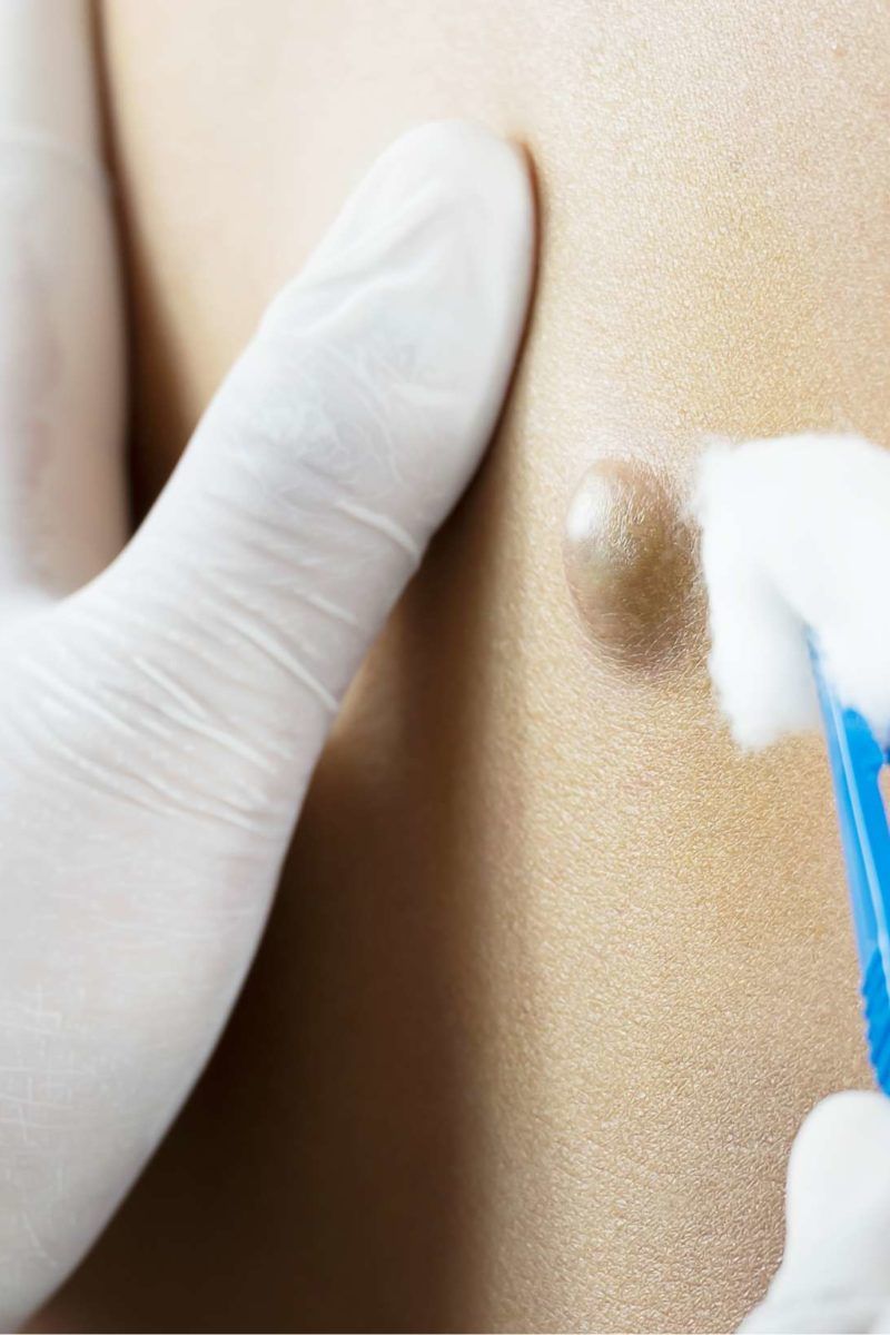 Cyst vs. tumor: Conditions, differences, and diagnosis