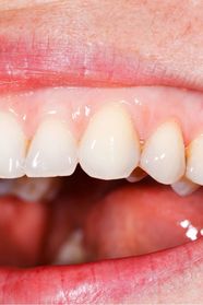 What Do White Ps On Gums Mean Infoupdate