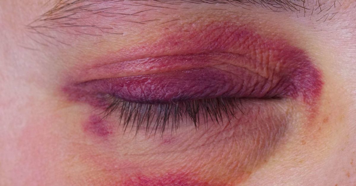 Broken eye socket: Pictures, causes, and treatment
