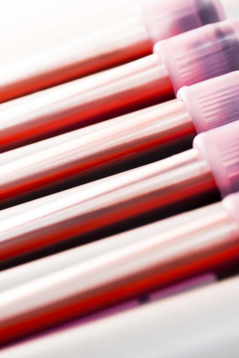 Epstein-Barr virus test: Procedure, results, and interpretation