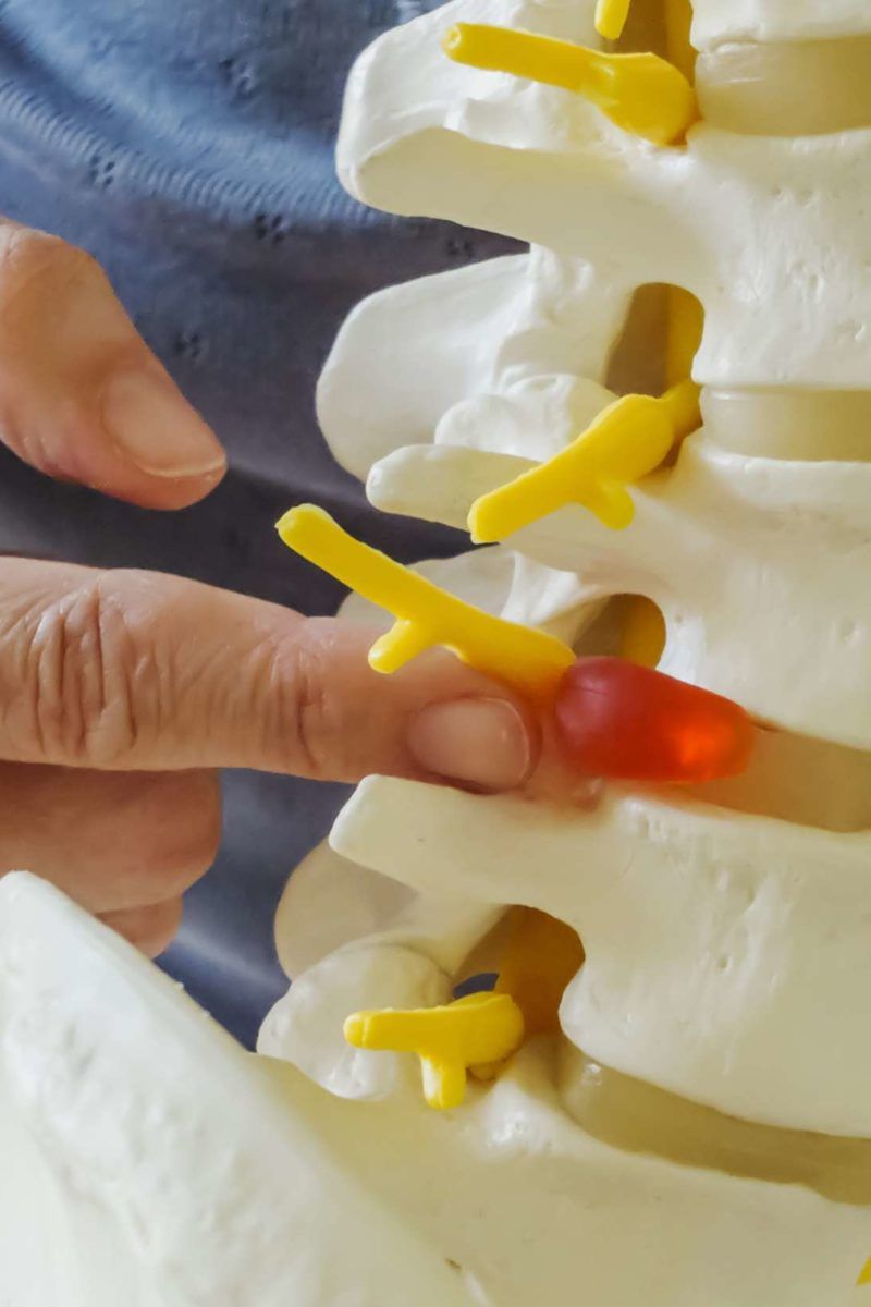 Disc Desiccation Symptoms Causes Exercises And Treatments
