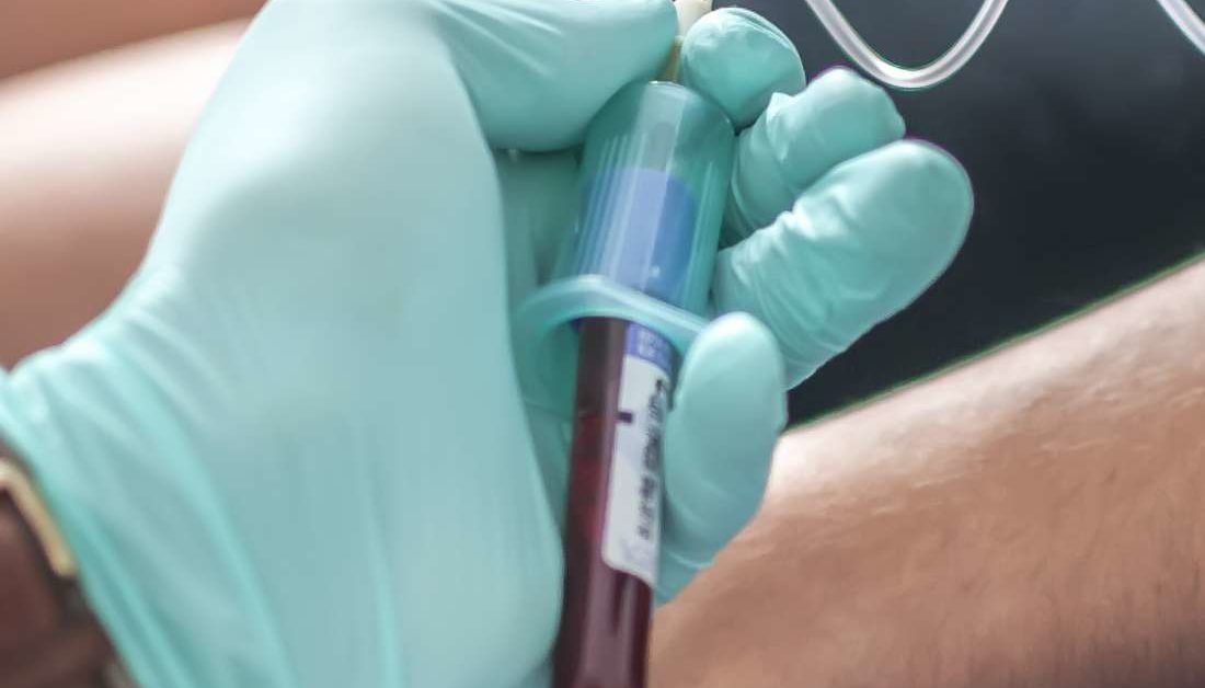 RPR Test and syphilis: Procedure and results