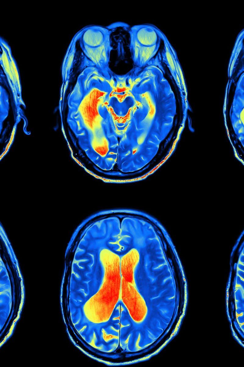 Rheumatoid arthritis: How chronic inflammation affects the brain