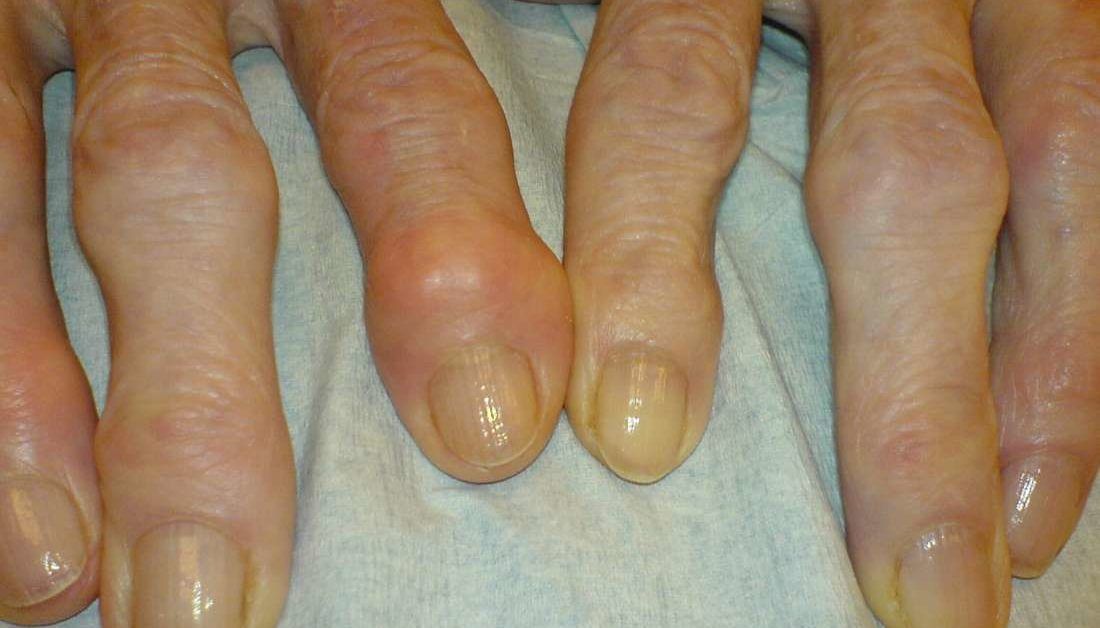Heberden's nodes: Causes, symptoms, and treatment