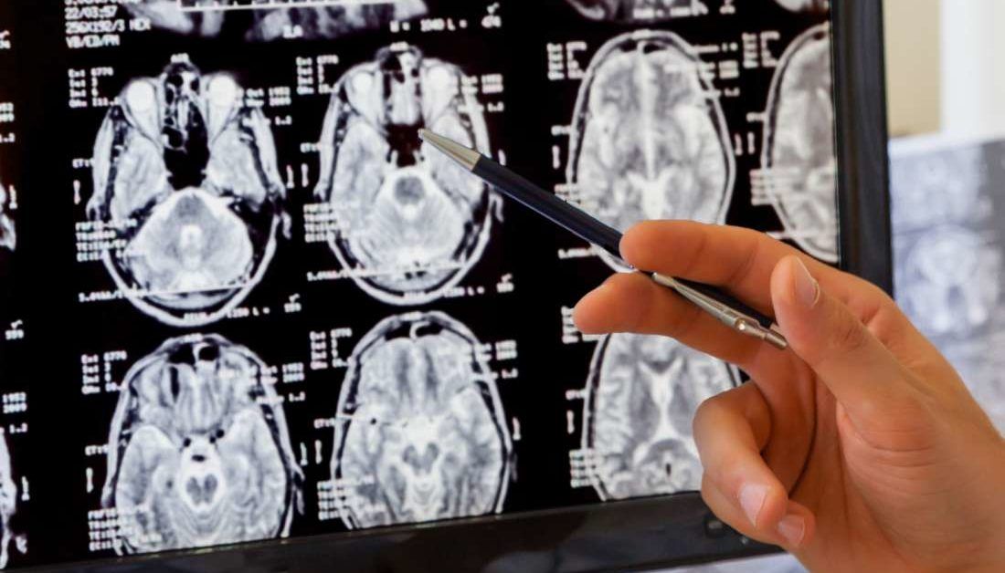 Cerebral edema: Symptoms, causes, treatment, outlook