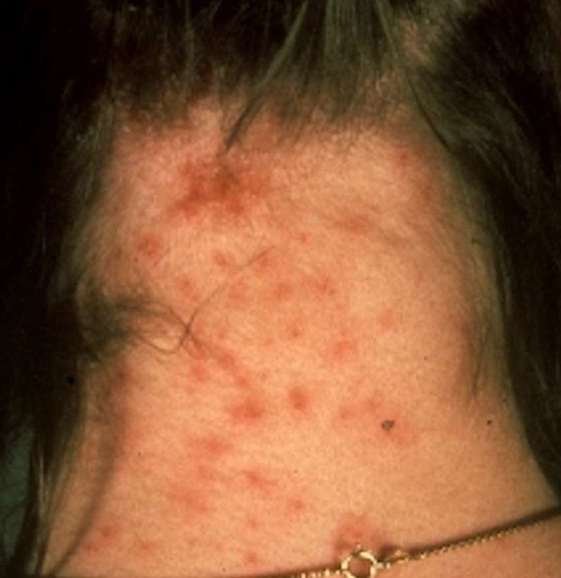 Lice bites: Pictures, identification, and treatment
