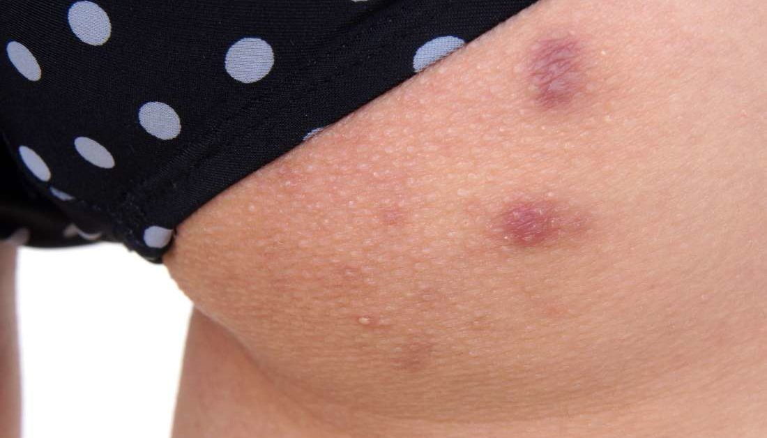 Butt acne products store