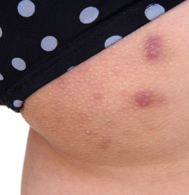 Butt acne: Home and natural treatments for folliculitis