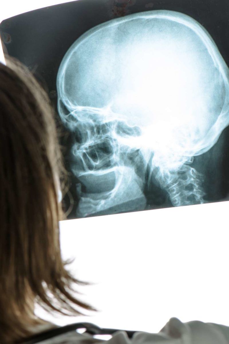 Skull fracture: Types, symptoms, and long-term effects