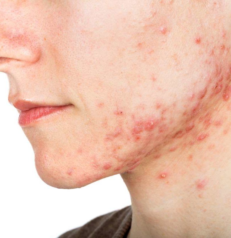 A new vaccine could wipe out acne