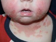 Red Itchy Rash Around Child S Mouth Infoupdate Red Itchy Rash Around Child S Mouth Infoupdate