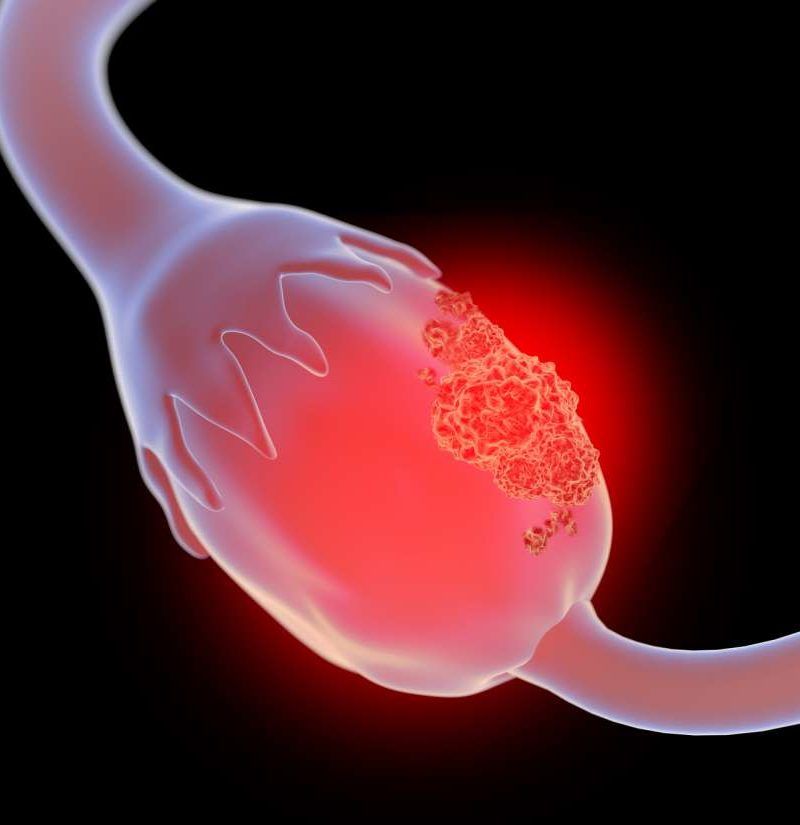 Ovarian cancer: Scientists find a way to launch dual attack