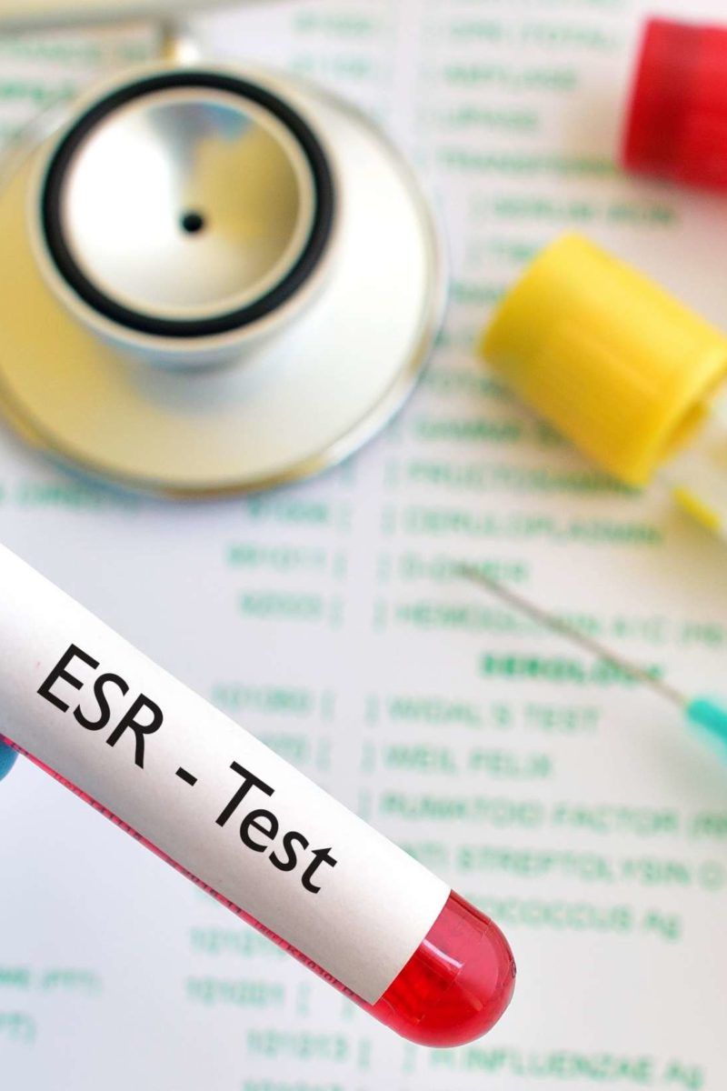ESR test: Procedure, results, and risks