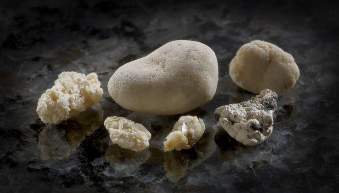 Dissolve kidney stones store