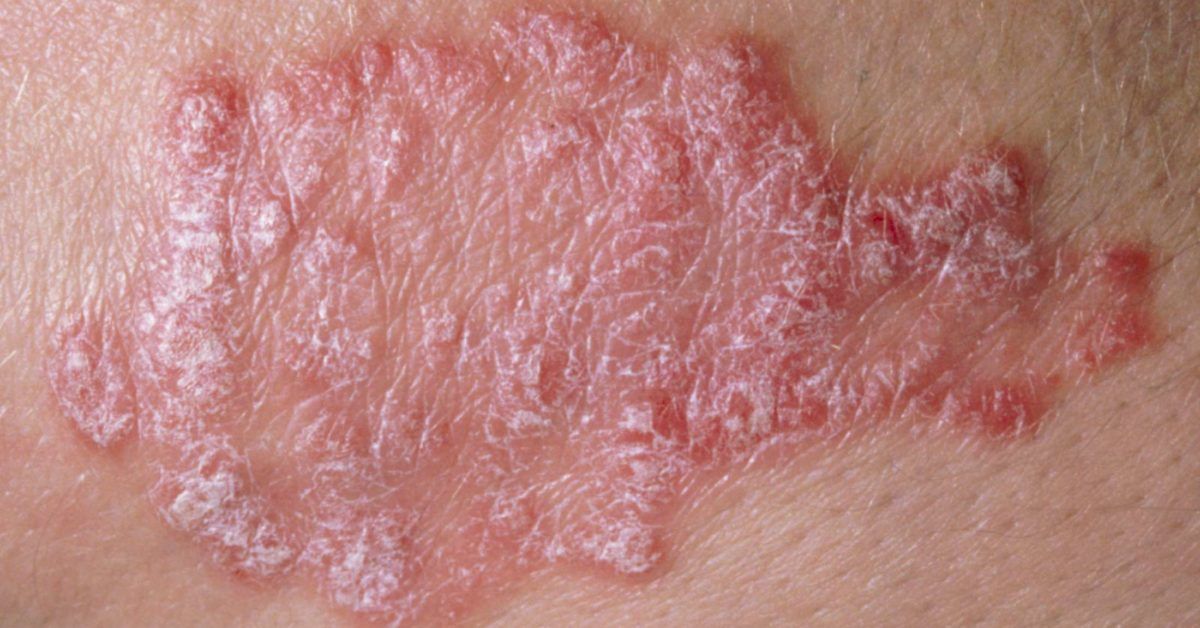 Psoriasis vs. lupus: Similarities and differences