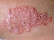 What Does Lupus Skin Rash Look Like Infoupdate What Does Lupus Skin Rash Look Like Infoupdate