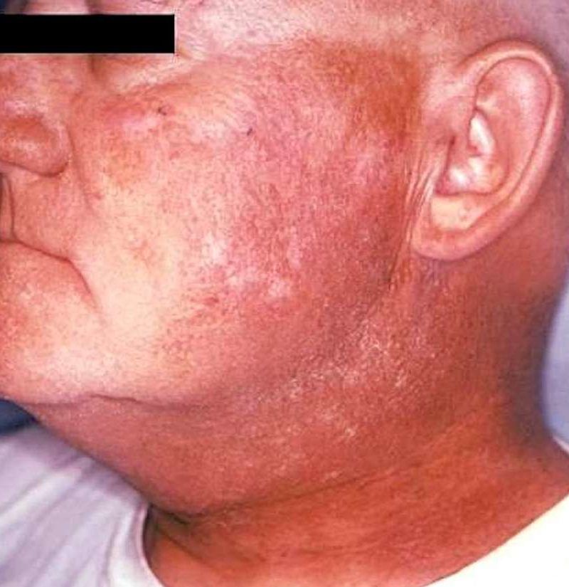 Radiation dermatitis: Symptoms, treatment, and prevention