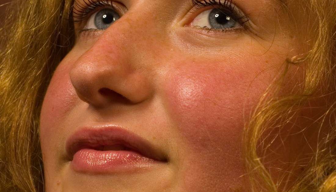 Piel enrojecida: causas y cuándo consultar a un médico