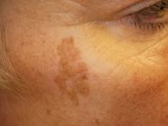 What Causes Black Spots On The Face And Neck Infoupdate