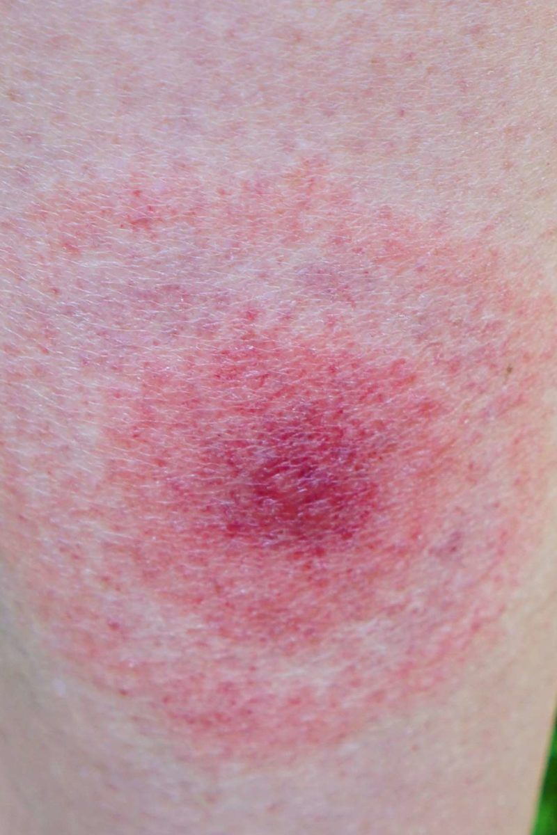 Lyme disease rash: Symptoms, stages, and identification