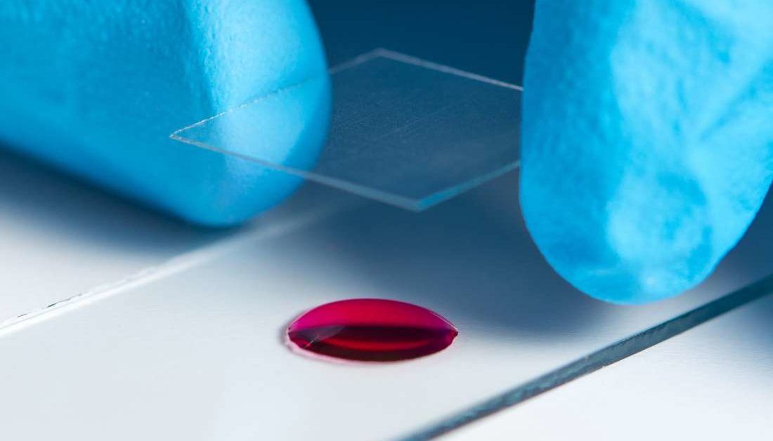 Alanine aminotransferase (ALT) test: Uses and results