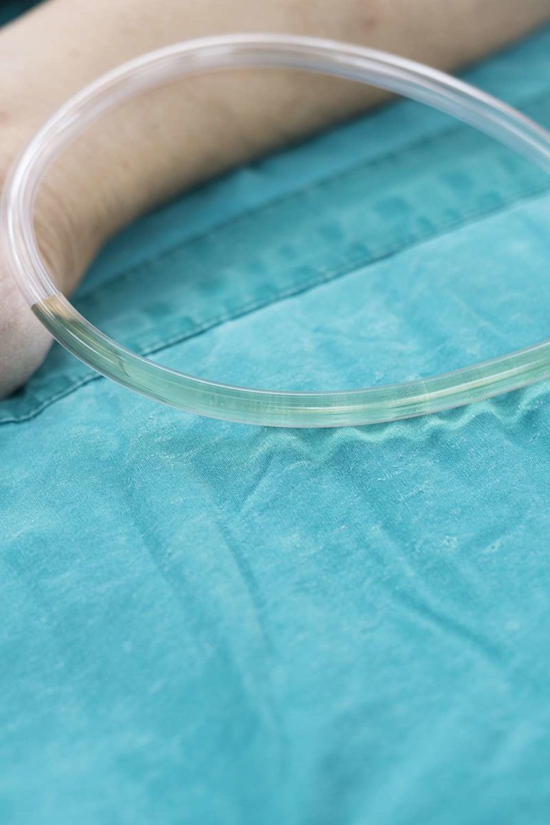 Urinary catheter: Uses, types, and what to expect