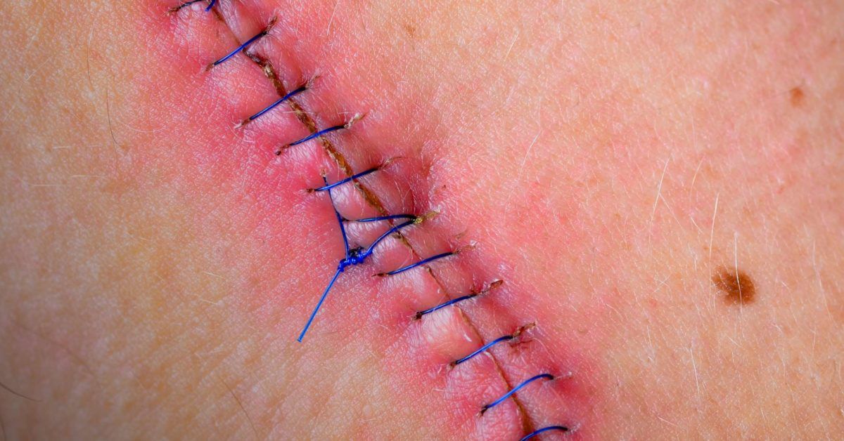 How to remove stitches safely at home