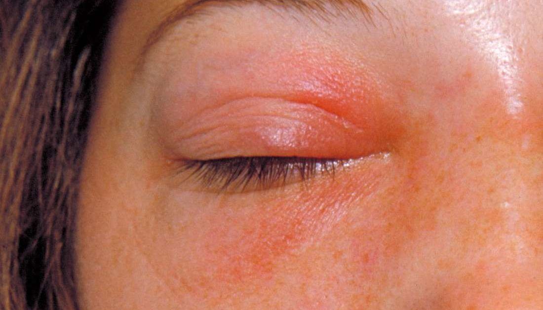 Orbital cellulitis: Symptoms, causes, and treatment