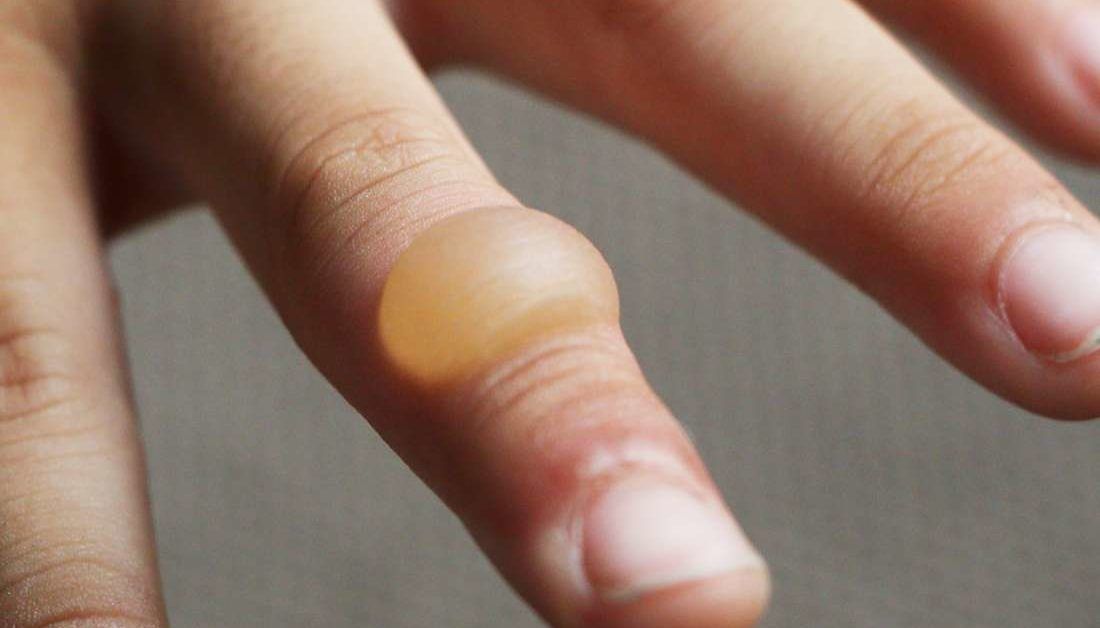 Burn blister: First aid, treatment, and types of burns