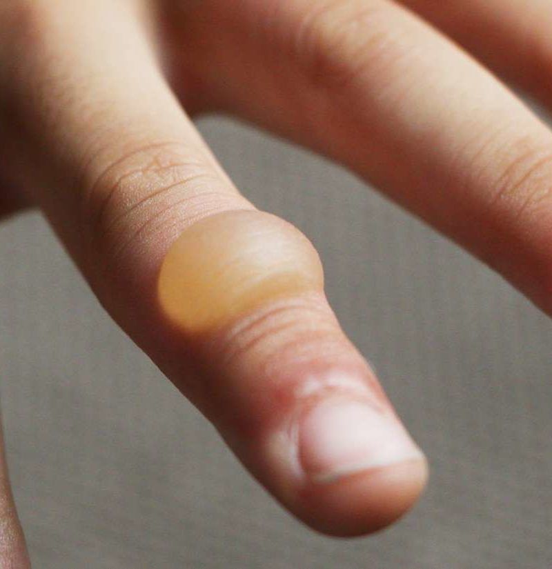 Burn blister: First aid, treatment, and types of burns