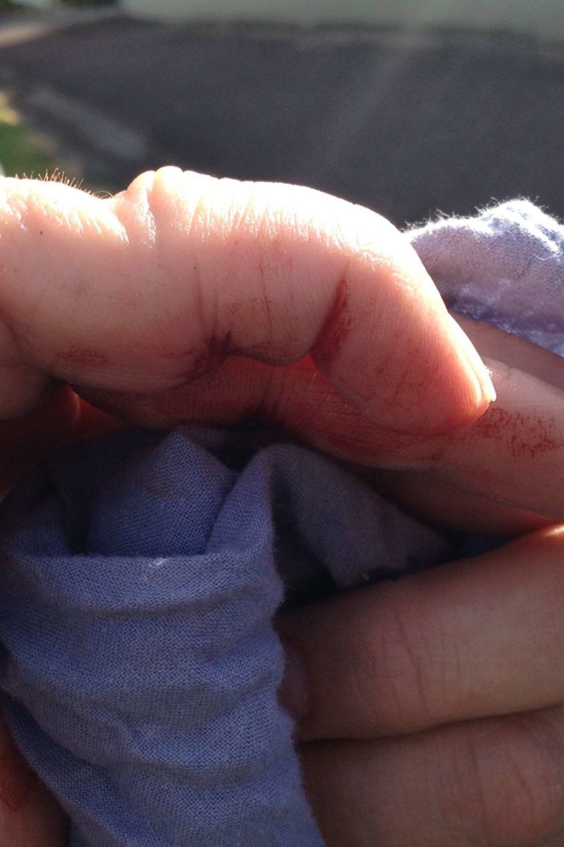 Dislocated finger: What to do plus symptoms, causes, and treatment