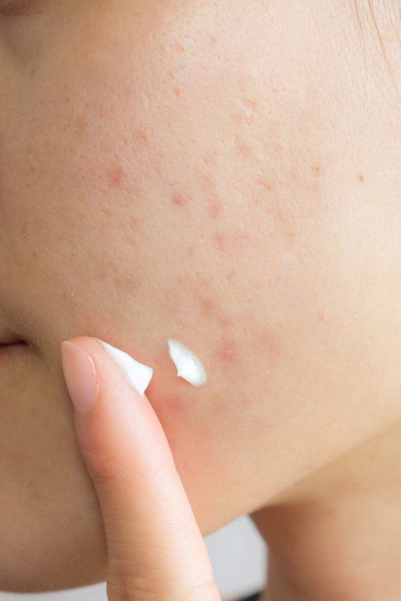 Cómo eliminar las cicatrices del acné: Tratamientos y remedios caseros