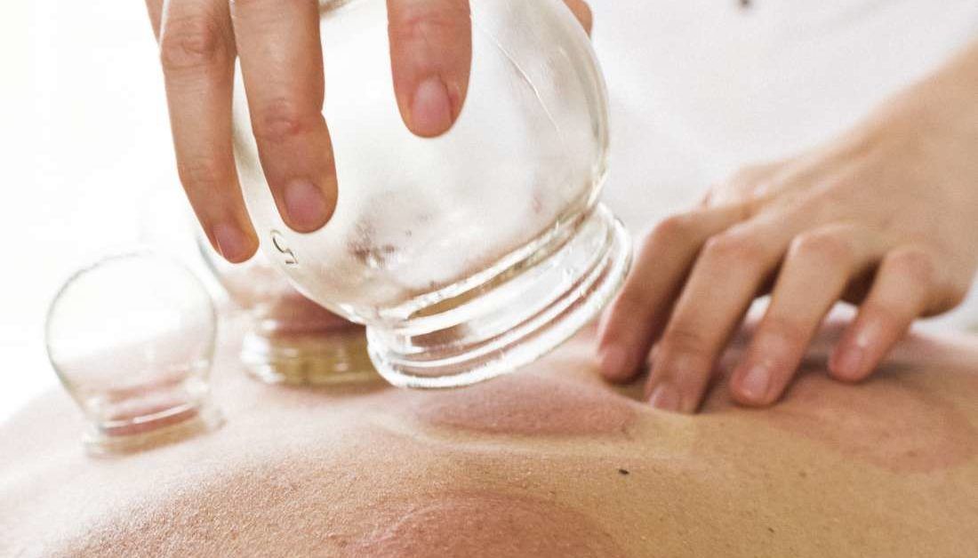 Cupping therapy: Benefits, how to do it at home, and side effects