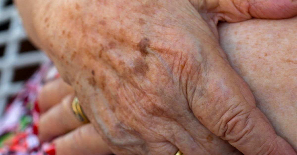 Manchas oscuras en la piel: Causas, tratamientos y remedios