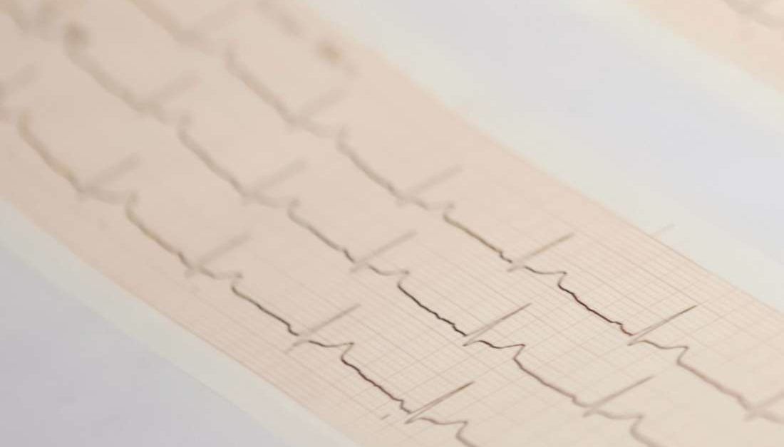 Abnormal EKG: Results, causes, and treatment
