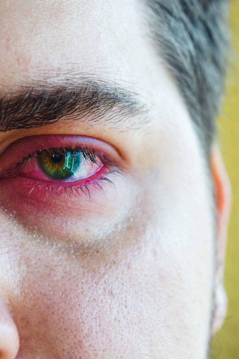 Sore eyelid: Causes, when to see a doctor, and treatment