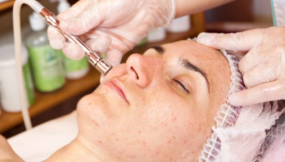 Ice pick scars: Treatment options, causes, and prevention